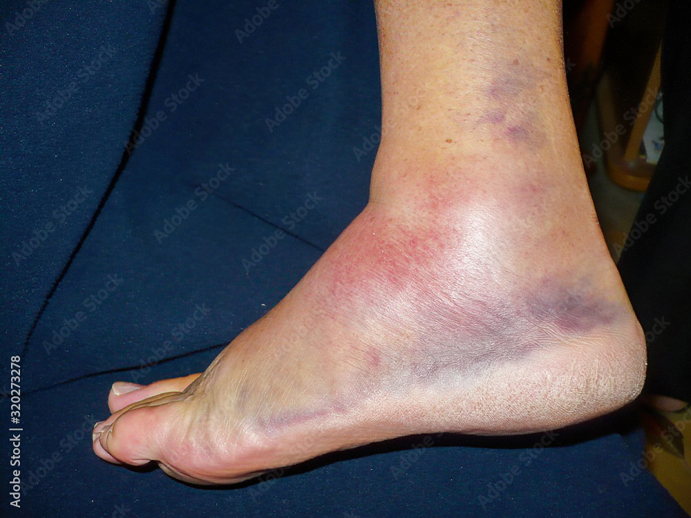 detail of ankle injury with dislocation and sprains Stock Photo | Adobe ...