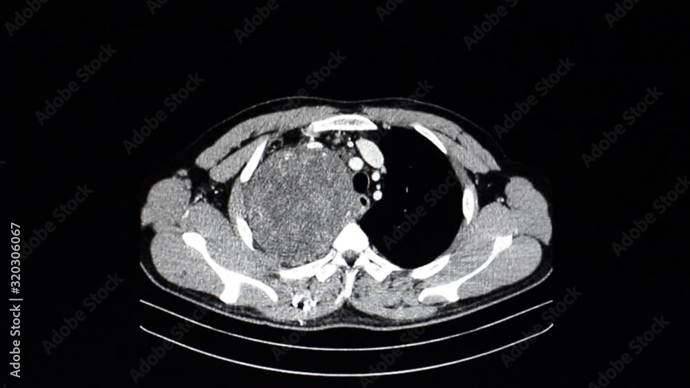 Cineview of CT scan of a chest of patient showing large tumor in right ...