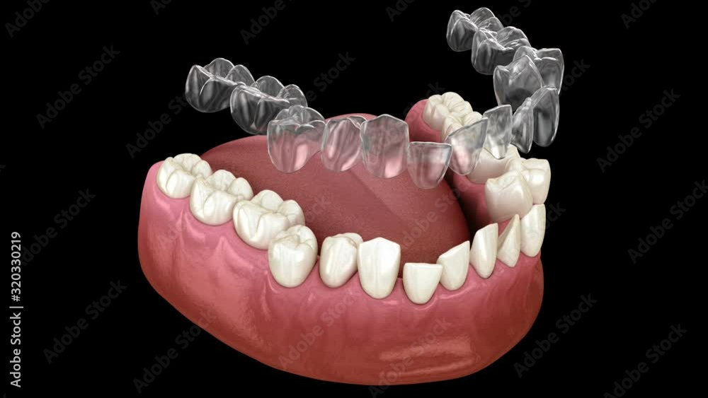 Invisalign braces or invisible retainer make bite correction. Medically ...
