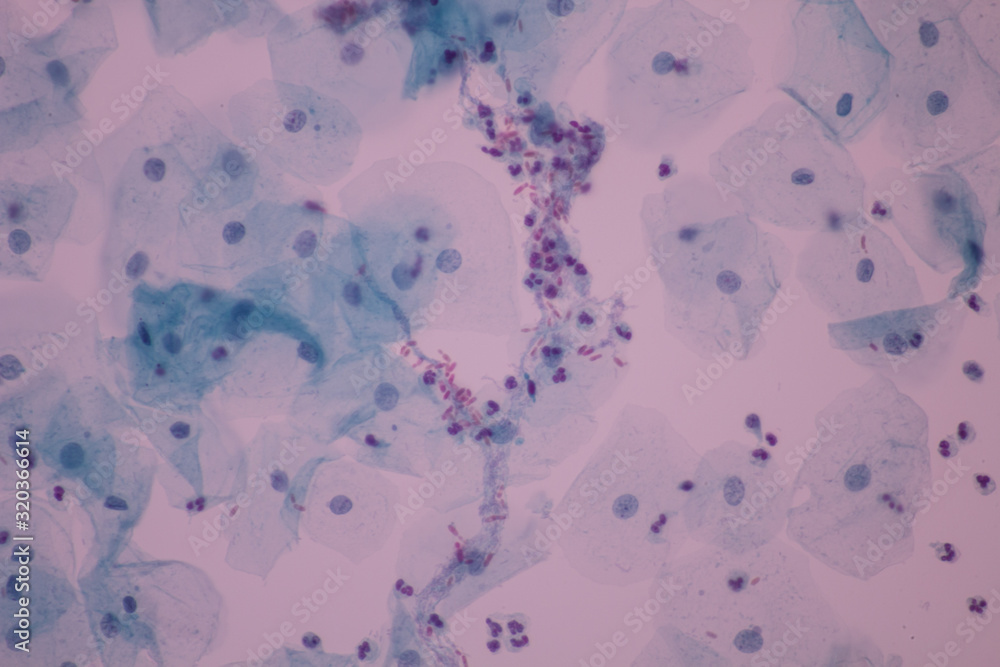 View in microscopic of Candidiasis, fungus infection (Yeast and ...