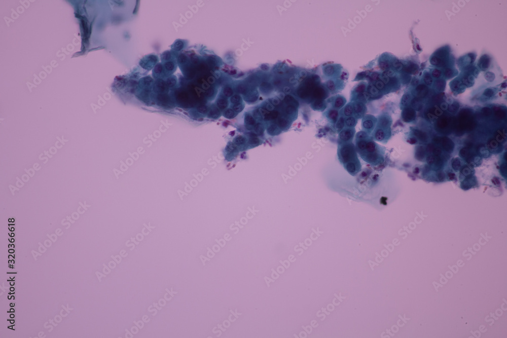 View in microscopic of Candidiasis, fungus infection (Yeast and ...