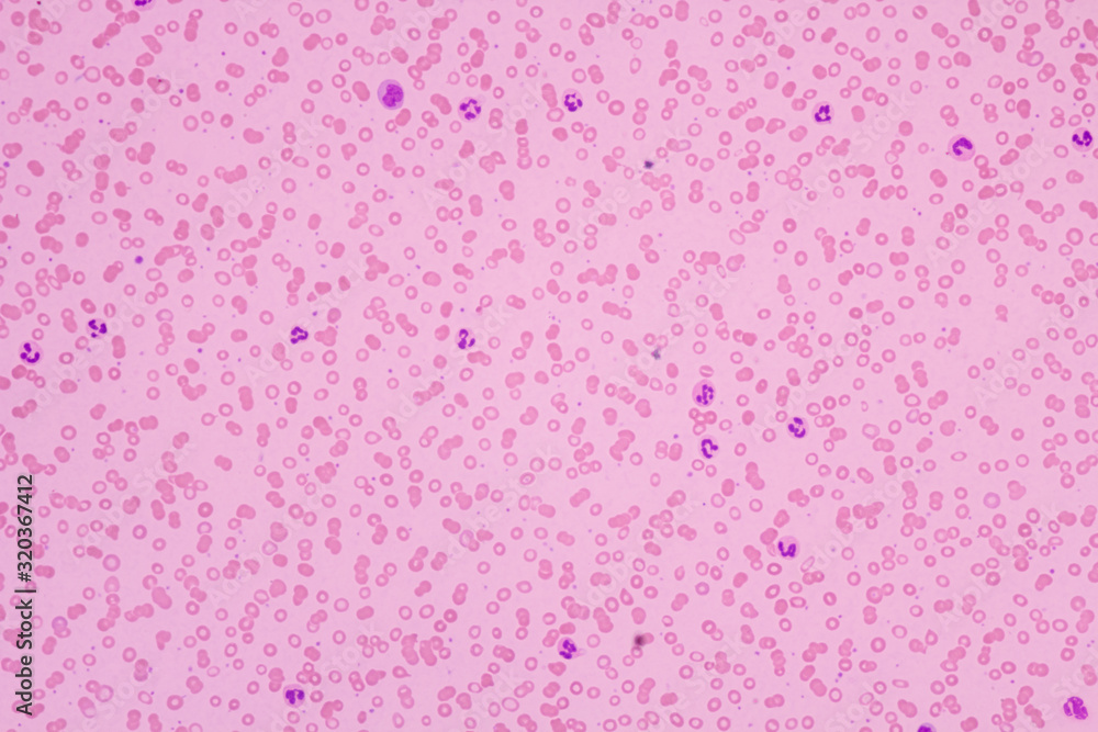 Human blood smear view in microscopy.Complete blood count for treatment ...