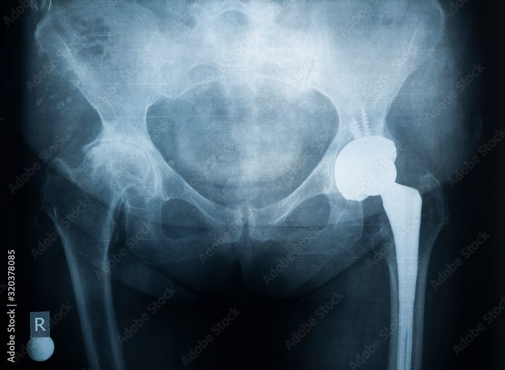 Poster X-ray of the prosthesis of the left hip joint – Wandbild ...
