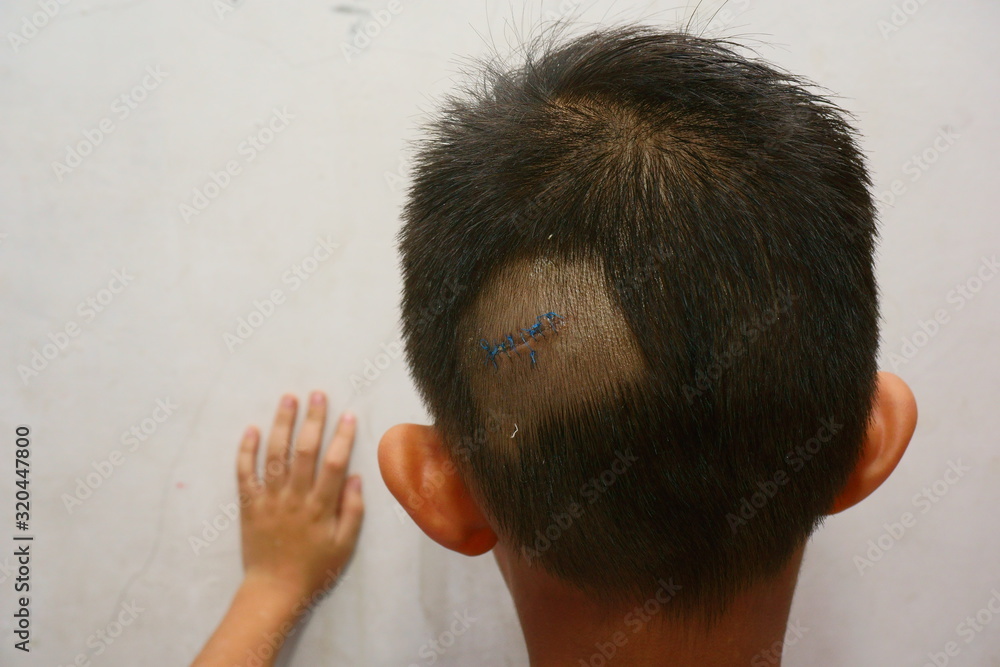 there was a boy with a scratch on the head, who had just been sutured ...