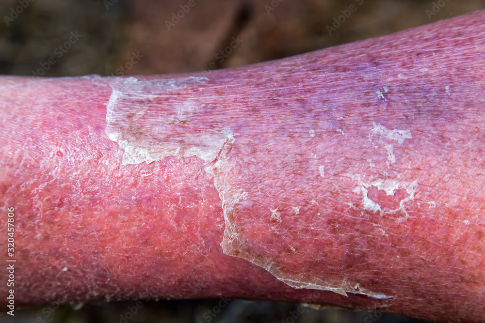 Cellulitis on leg and foot of mature diabetic man in daylight outdoors ...