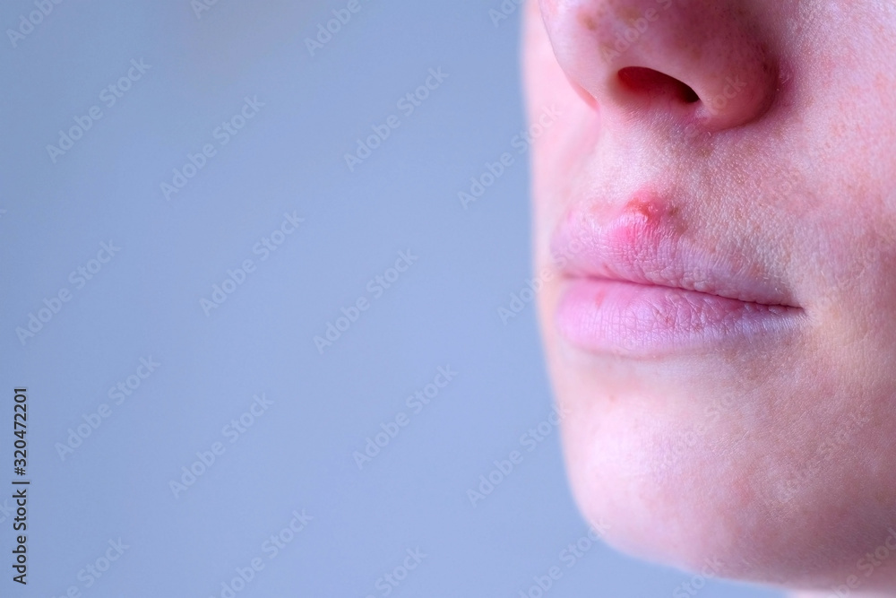Herpes virus on human lips. Woman with herpes sore on lip mouth ...