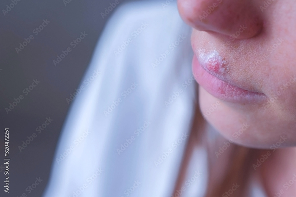 Herpes virus on human lips. Woman with herpes sore on lip mouth with ointment, closeup mouth ...