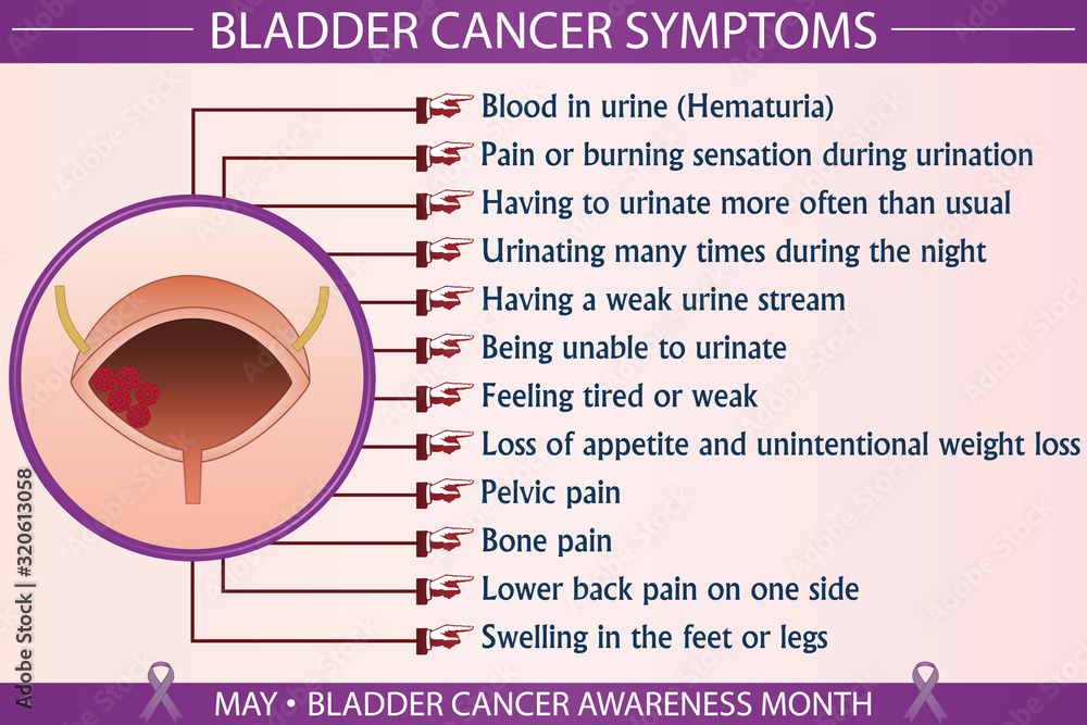 Vetor de Bladder cancer symptoms infographic vector illustration ...