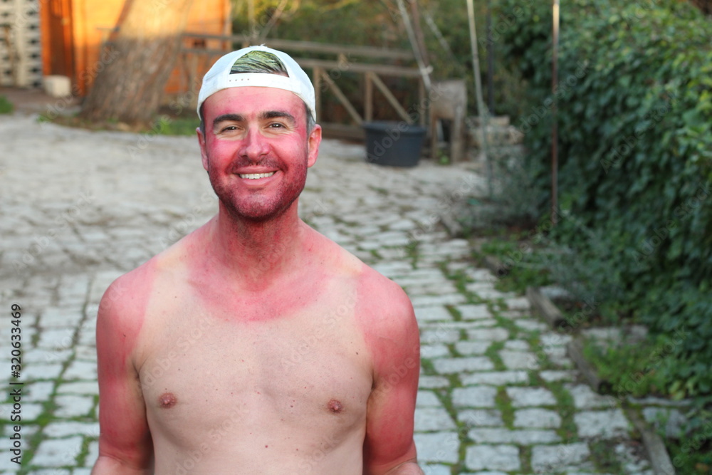 Sunburned young man with extreme tan lines Stock Photo | Adobe Stock