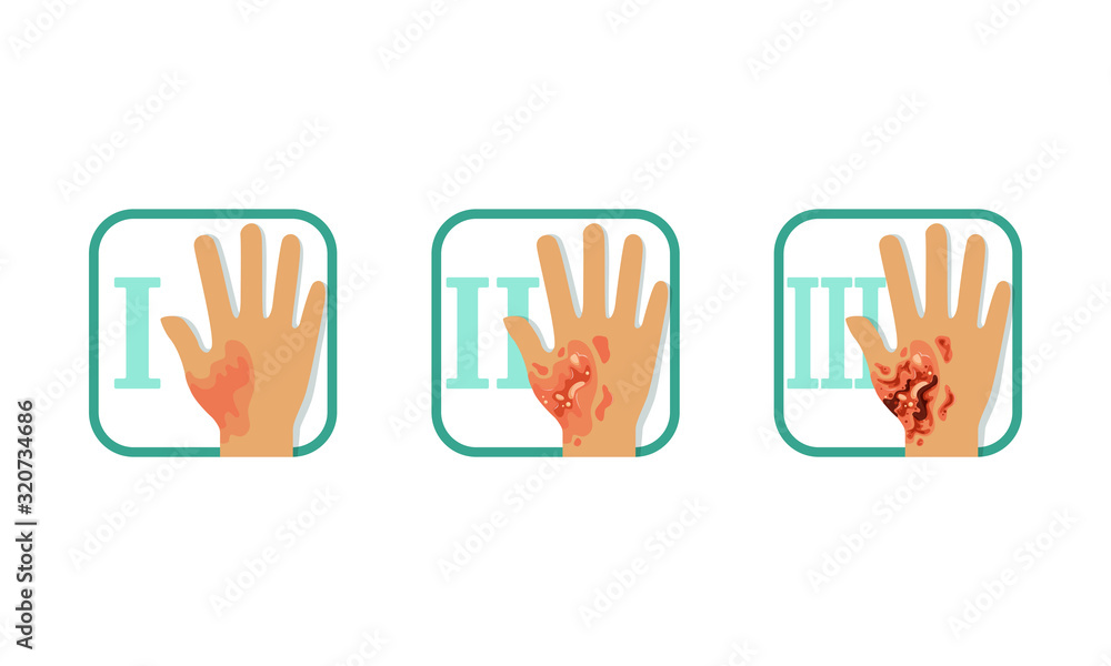Degree of Skin Burns Set, Normal to Serious Injury, First, Second and ...