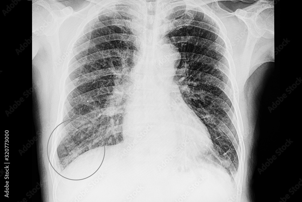 Chest xray of a patient with viral pneumonia Stock Photo | Adobe Stock
