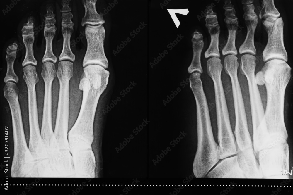 X-ray of the left foot of a person's leg, determination of injury ...