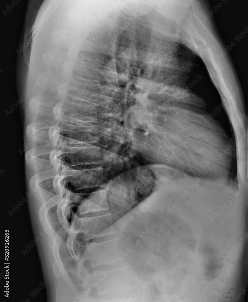 x-ray of the thoracic spine in a lateral projection Stock Photo | Adobe ...