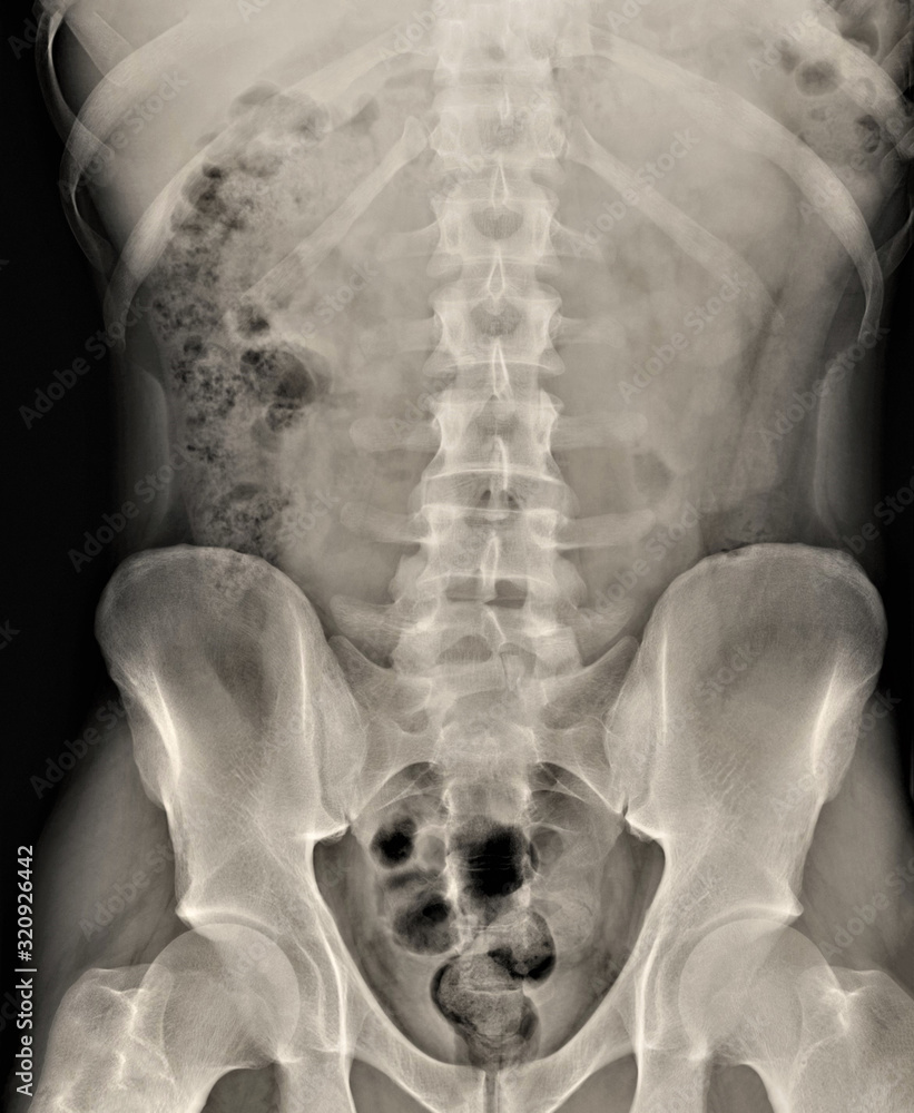 x-ray of the abdominal cavity and pelvis in direct projection, medical ...