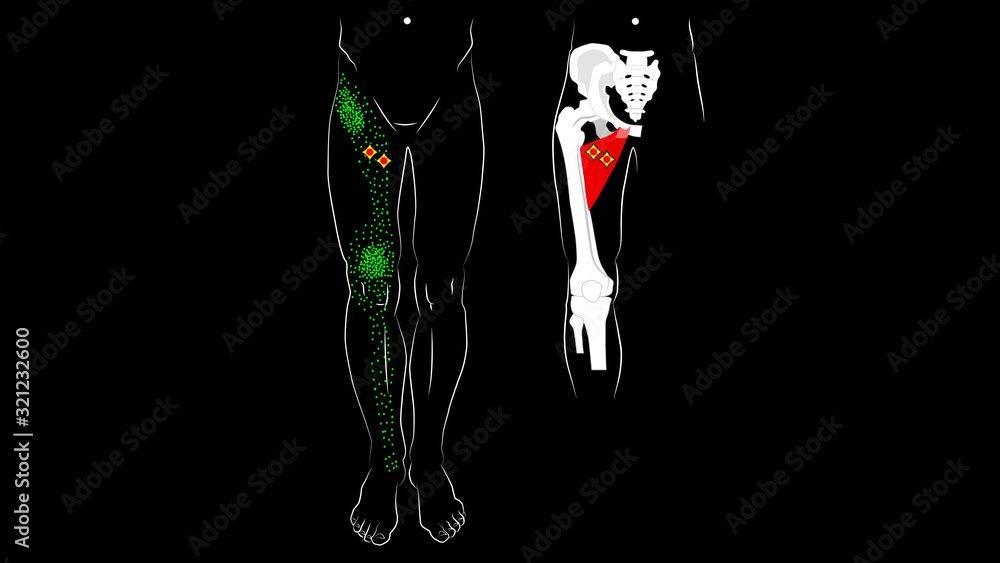 Adductor longus muscle. Adductor brevis muscle. Trigger points and ...
