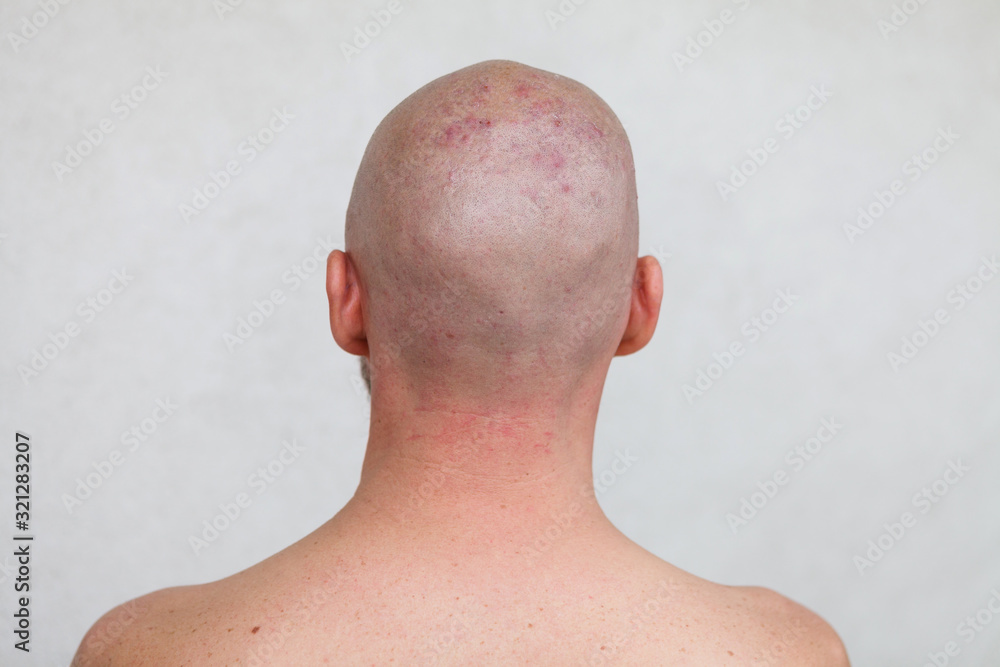 Man's shaved head with diseased skin, acne and eczema Stock Photo ...