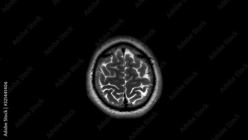 Pathologie,Magnetic Resonance Imaging (MRI), Human brain real MRI scan ...