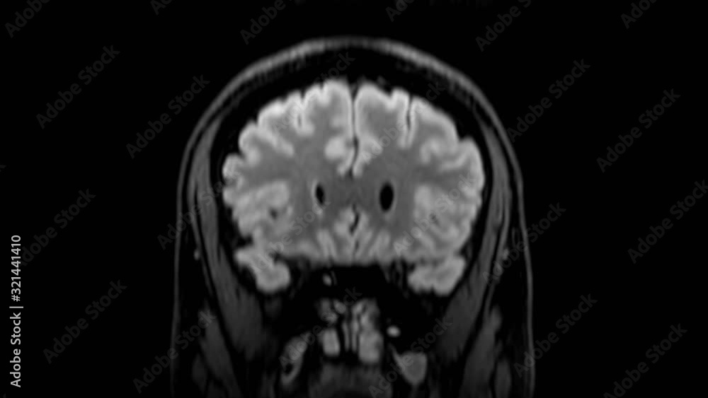 Vidéo Stock Human Brain, Fluid-attenuated inversion recovery magnetic ...
