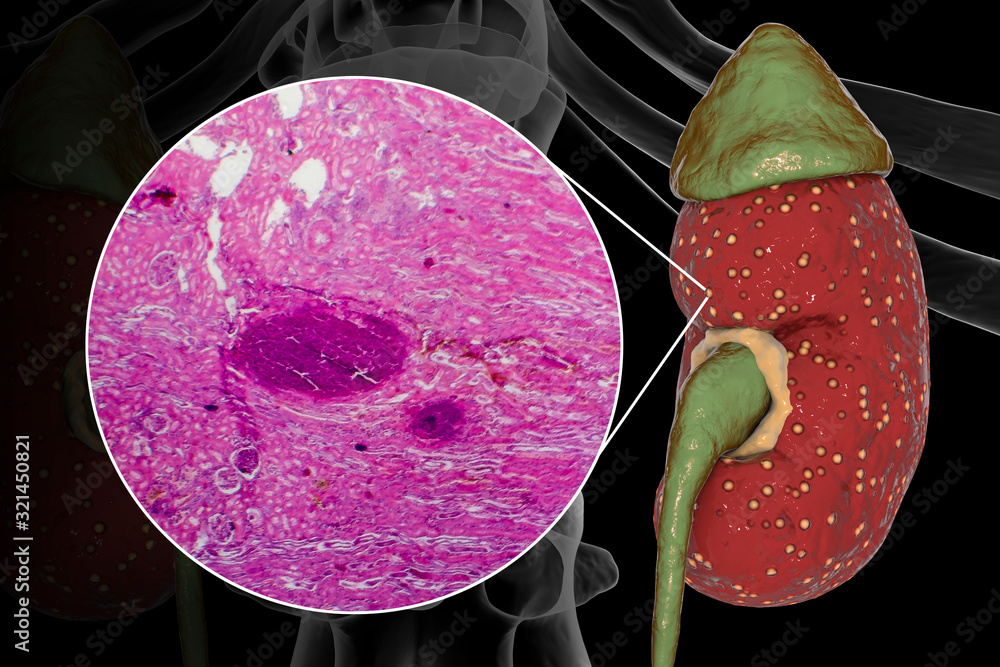 Acute pyelonephritis, 3D illustration showing gross morphology with ...