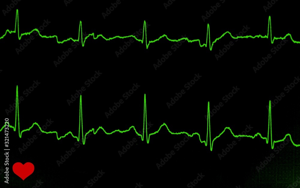 an EKG electrocardiogram with heart pulse Stock Photo | Adobe Stock