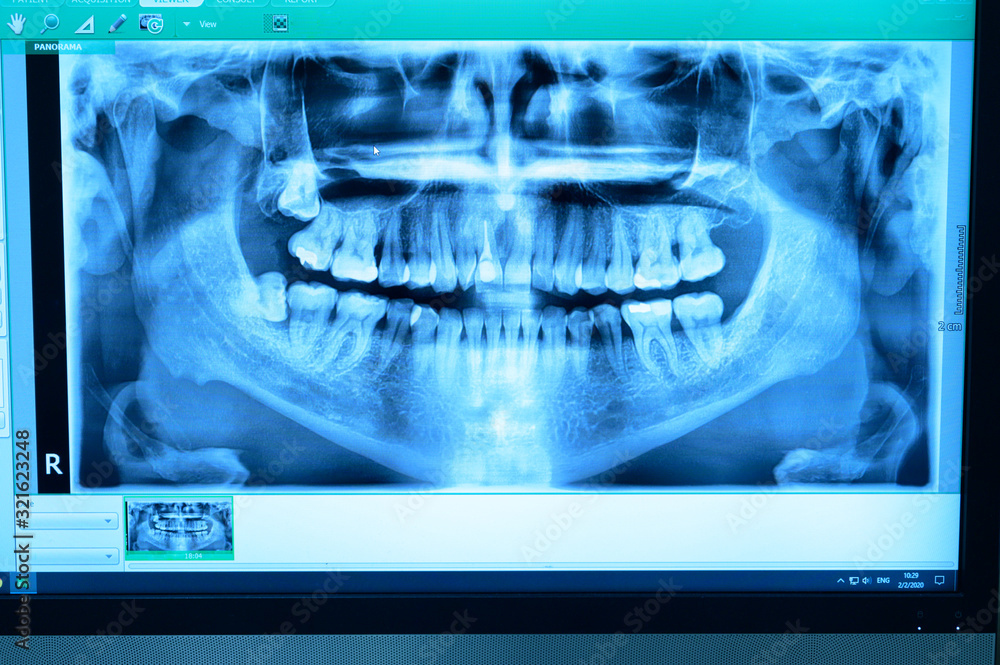 Image tooth x-ray in computer in blue tone style.Panoramic radiograph ...
