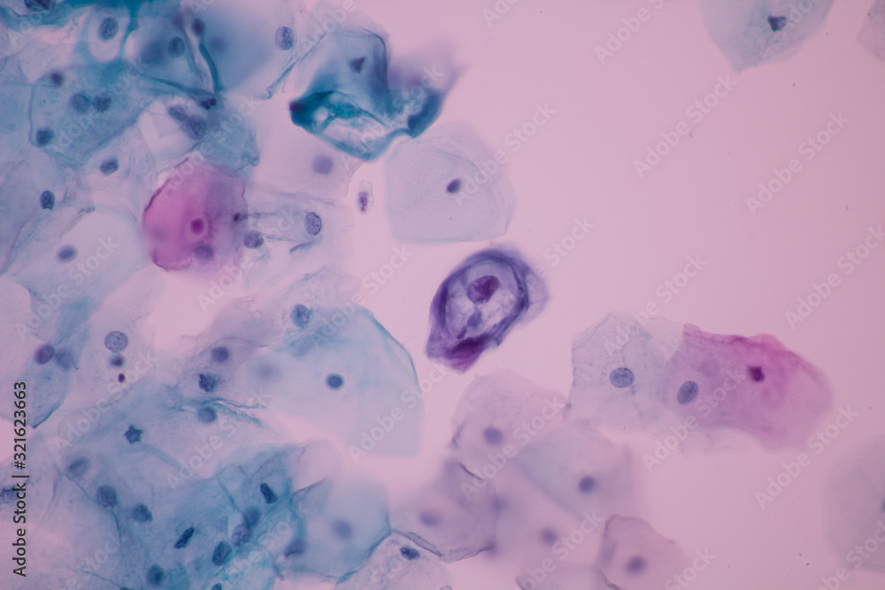 View in microscopic of abnormal human cervix cells.Koilocyte cell ...