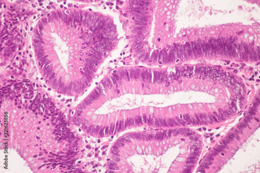 View in microscopic of ductal cell carcinoma, adenonocarcinoma from ...