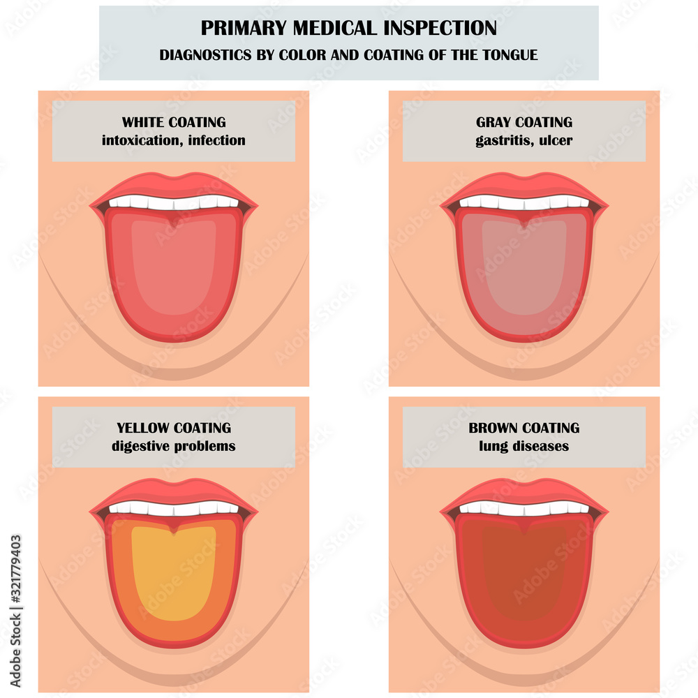 Collection of images of human tongue in different colors and coatings ...