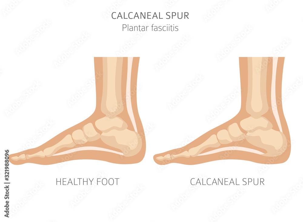 Calcaneal spur. Plantar fasciitis set. Medical desease infographics ...