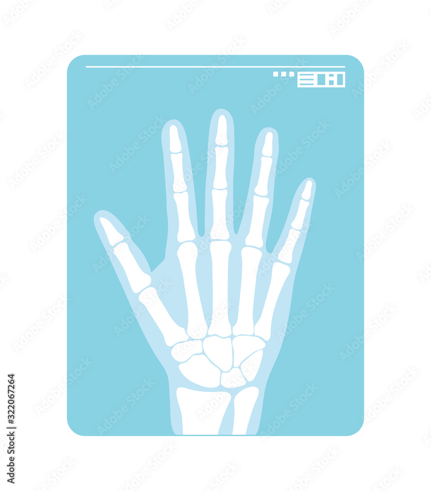 Radiogram of hand. X-ray or roentgenogram. Vector illustration of ...