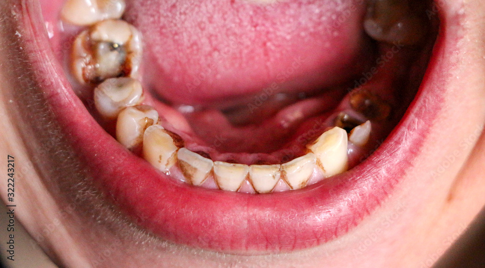 open mouth with broken, diseased teeth affected by caries and ...