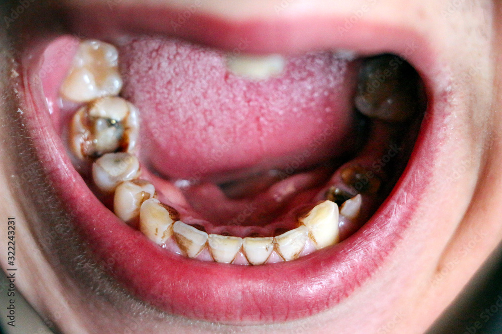 open mouth with broken, diseased teeth affected by caries and ...
