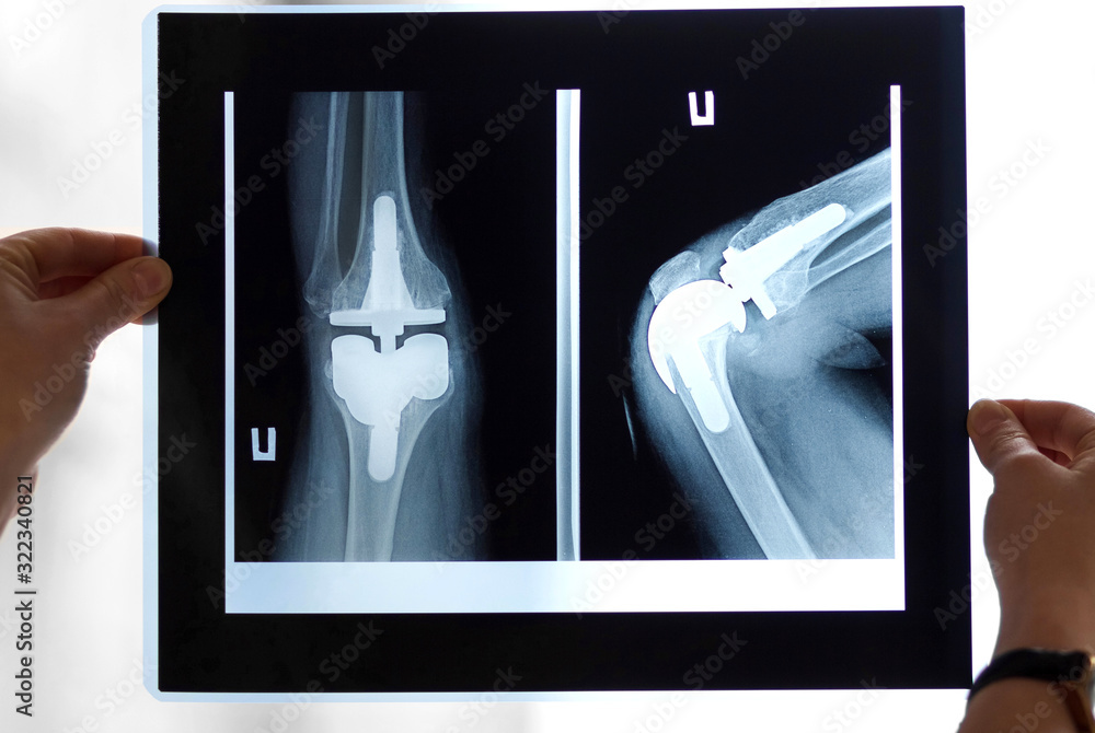 X-ray of the human knee Stock Photo | Adobe Stock