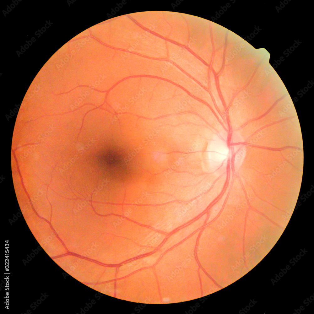 View inside human eye disorders - showing retina, optic nerve and ...