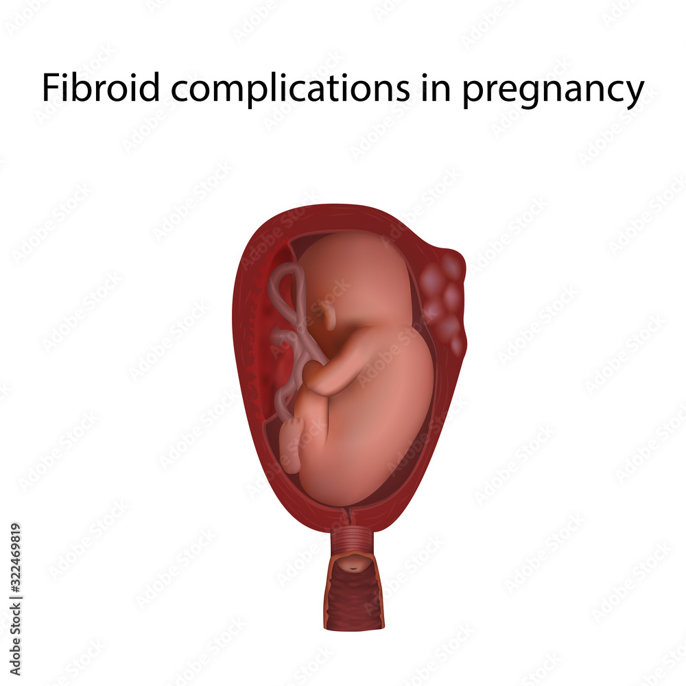Fibroid. Fetus in uterus, womb, placenta, umbilical cord. Hi-risk ...