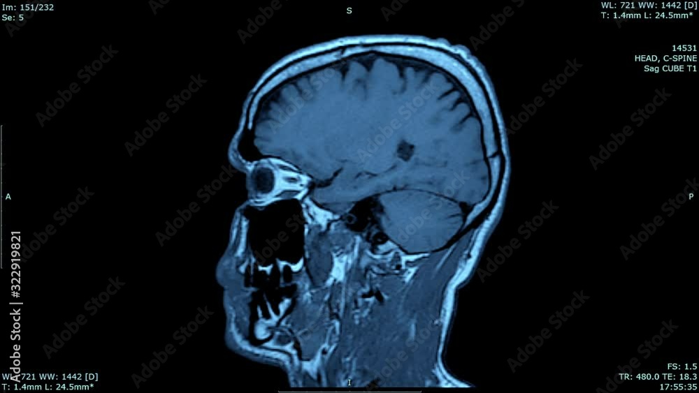 MRI scan. Human brain. Stock Video | Adobe Stock