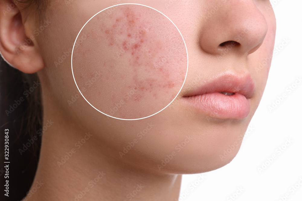 Teenage girl with acne problem on white background, closeup Stock Photo ...