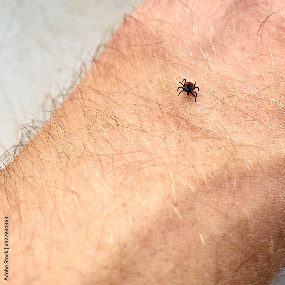 Infected female deer tick on hairy human skin. Ixodes ricinus ...