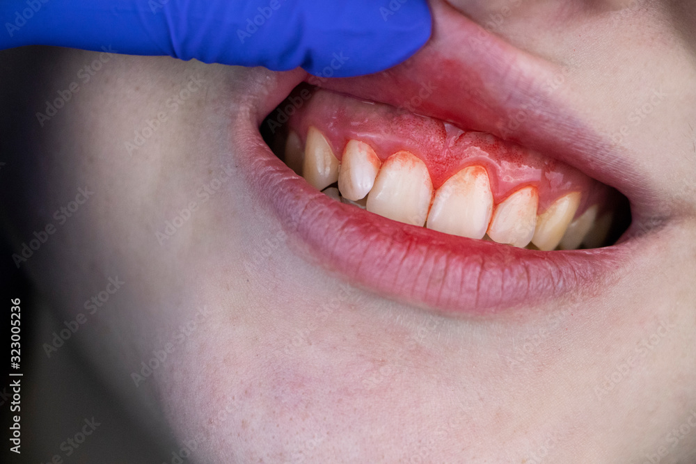 Gum bleeding and inflammation close up. A man examined by a dentist ...