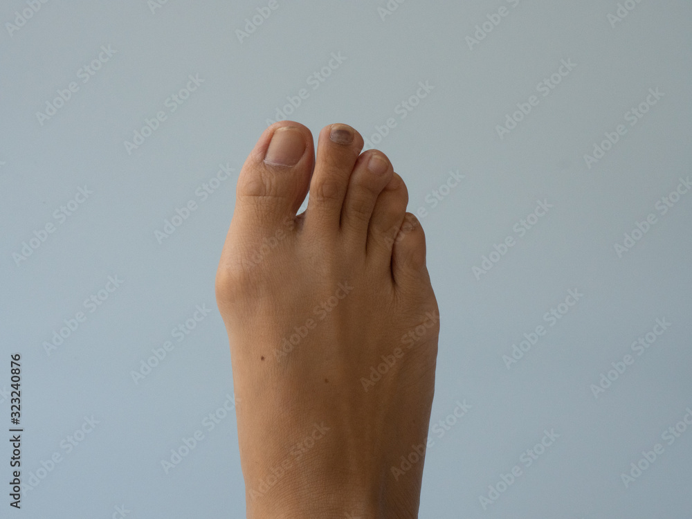 The subungual hematoma is occured like bleeding and bruising to ...