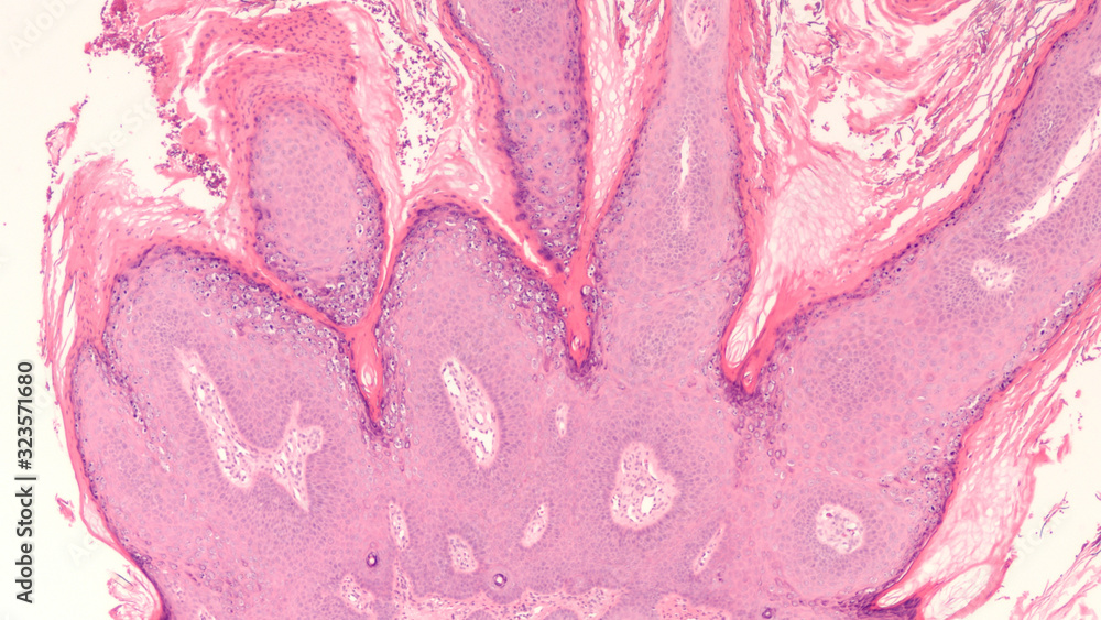 Photomicrograph of a skin biopsy showing the histology of verruca ...