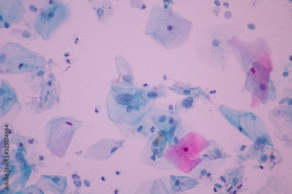 View in microscopic of Abnormal human cervix cells.Squamous epithelium ...