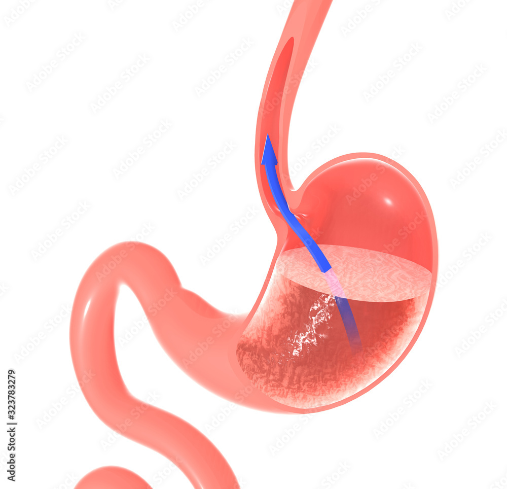 3D illustration of the inside of the stomach showing the reflux of food ...