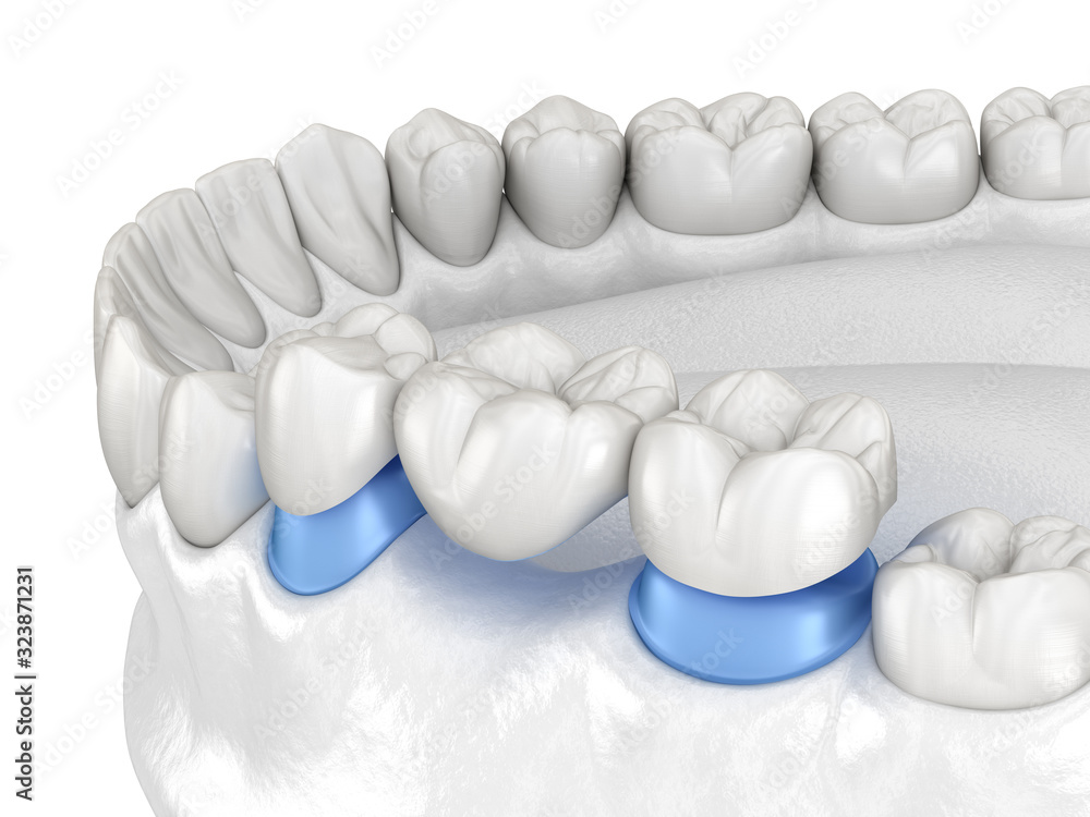 Porcelain Dental bridge of 3 teeth over molar and premolar. Medically ...