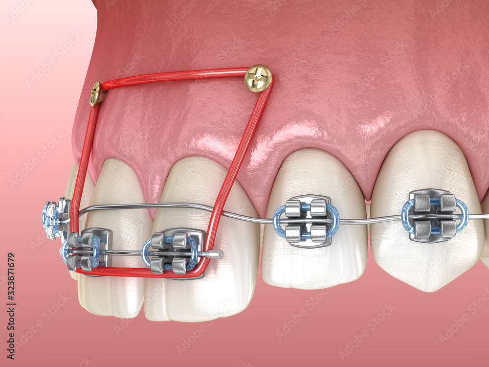 Overbite Correction Braces