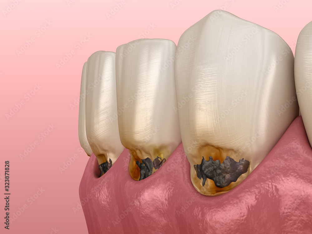 Cervical Caries On Frontal Teeth Medically Accurate Tooth 3d