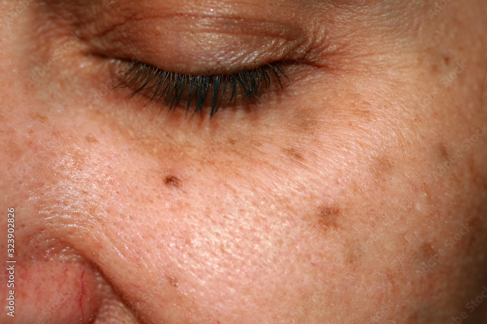 Brown spots on the face. Pigmentation on the skin. Brown age spots on ...