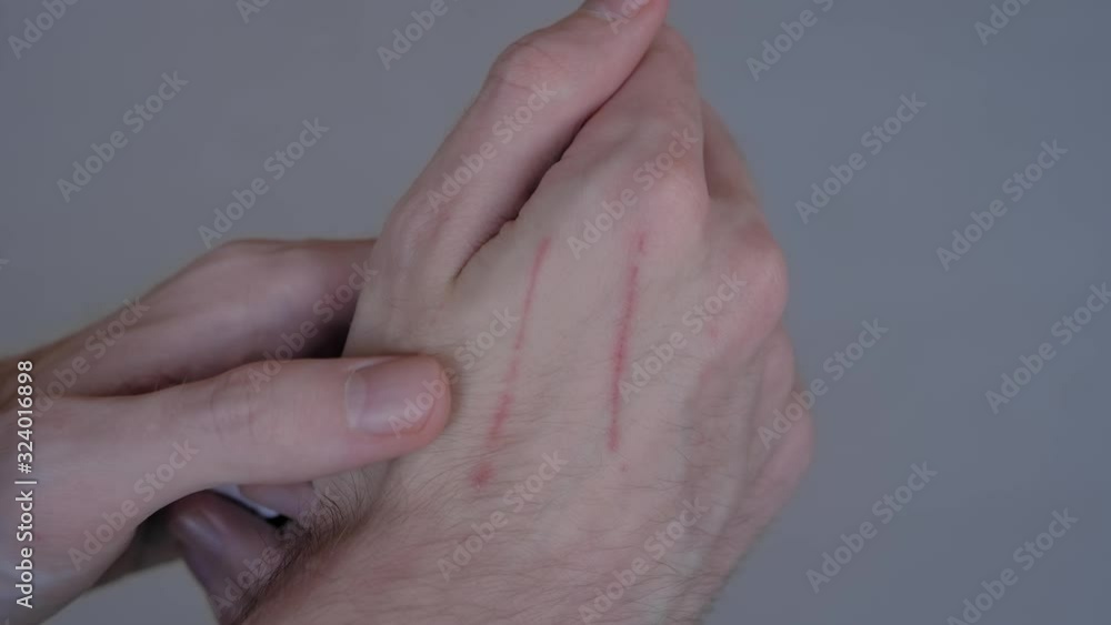 Close up view of man hand trying to treat cat scratches on skin with ...