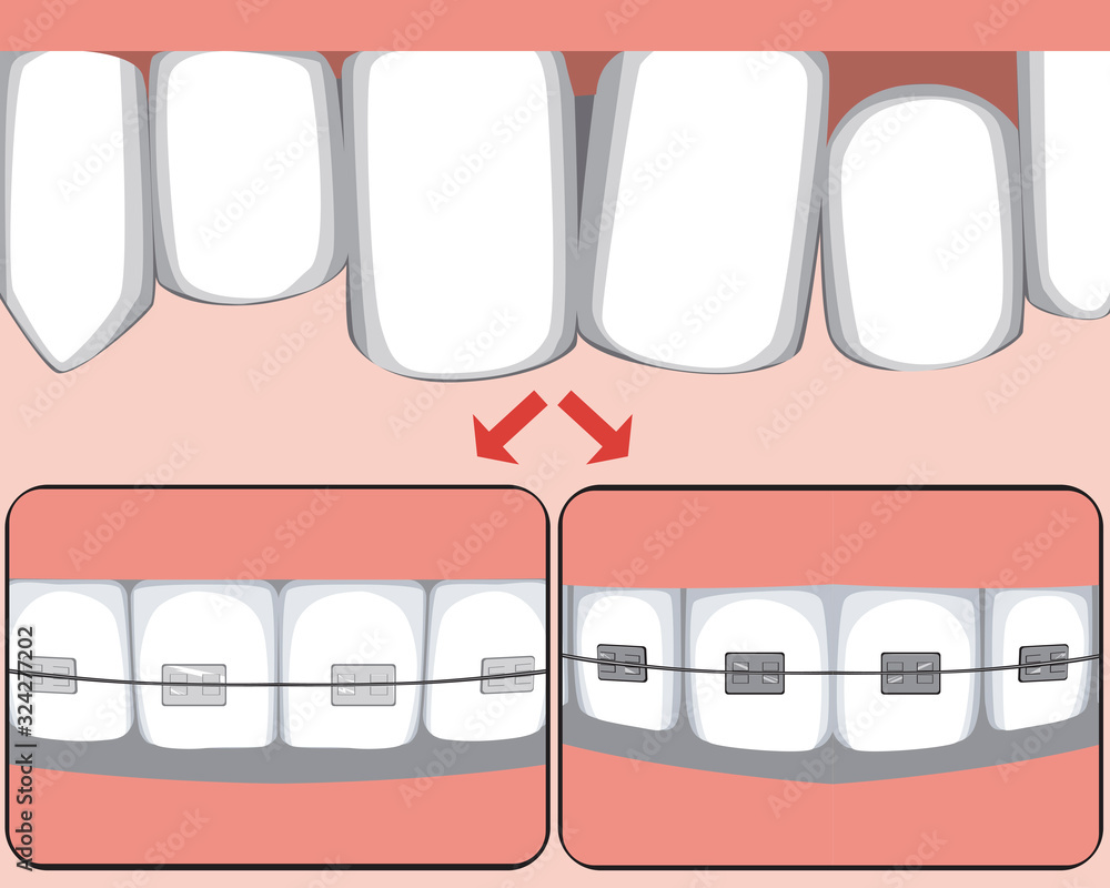 Crooked teeth on the upper jaw as a concept for bite treatment, vector ...
