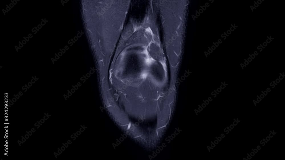 MRI knee or Magnetic resonance imaging of knee joint coronal stir view for fat suppression ...